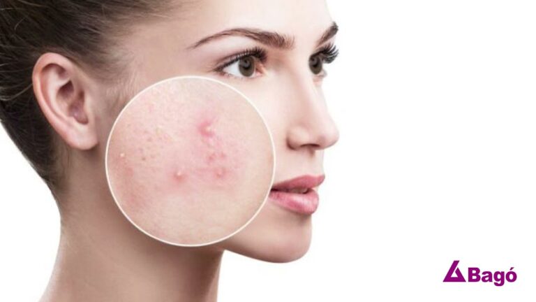 Descubre los 7 Tipos de Rojeces en la Cara: Causas y Soluciones ...