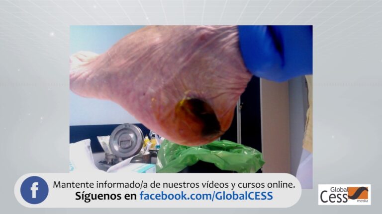 Estadio de las Úlceras por Presión: Guía Completa para su Prevención y ...