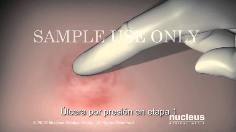 Tratamiento de Úlceras por Presión según su Estadio: Guía Completa y ...